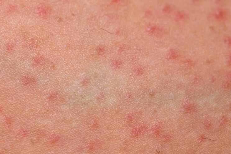 Folliculitis: Causes, Symptoms, Treatment and Prevention