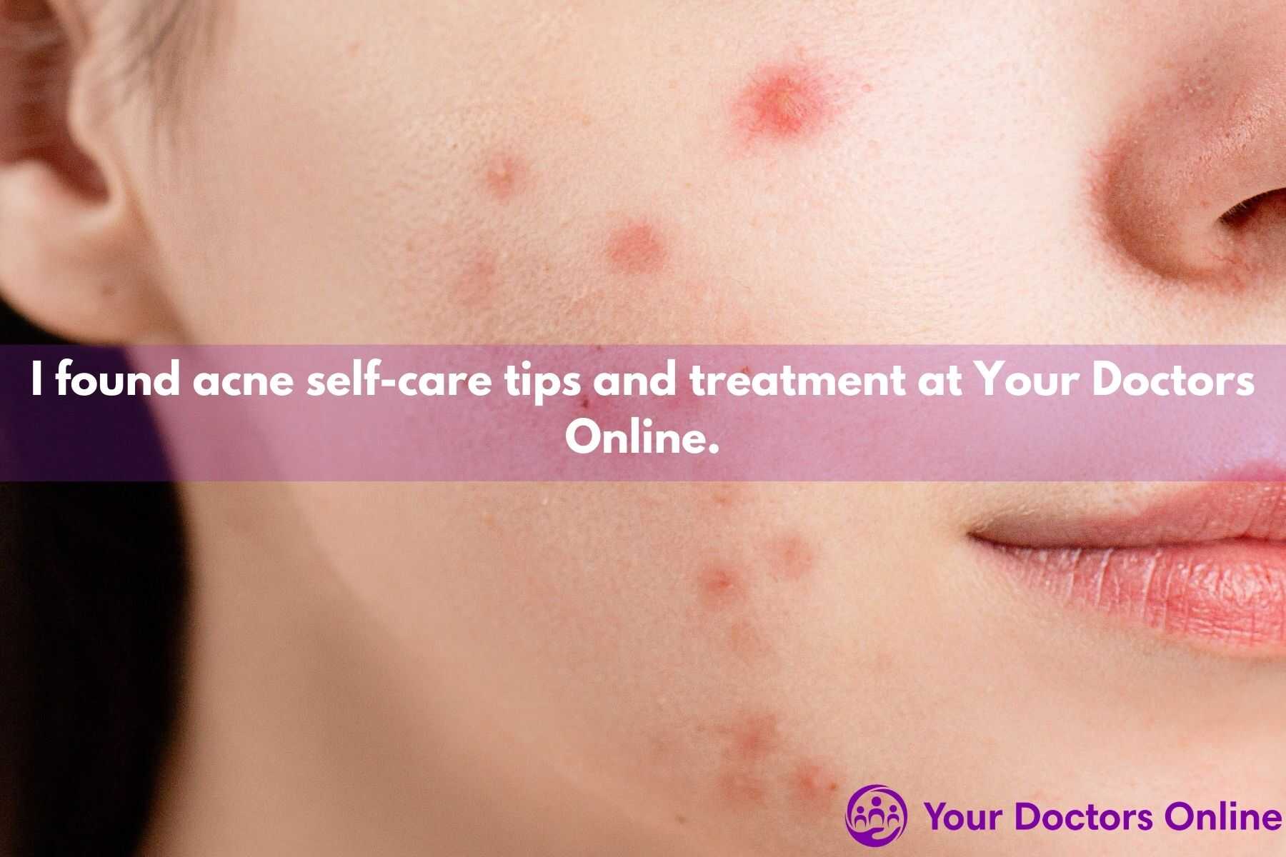 I Found Acne Self Care Tips and Treatment at Your Doctors Online.