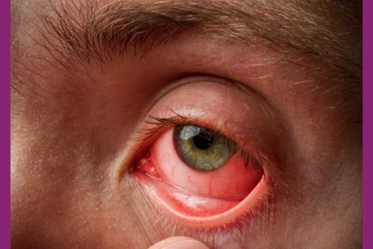 Your Doctors Online Helped Me Treat Bacterial Conjunctivitis!